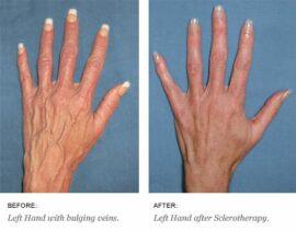 Hand Veins - Northwest Vein & Aesthetic Center
